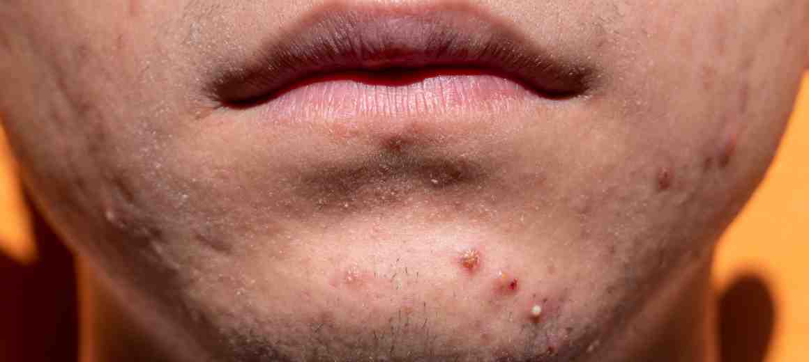 Acné